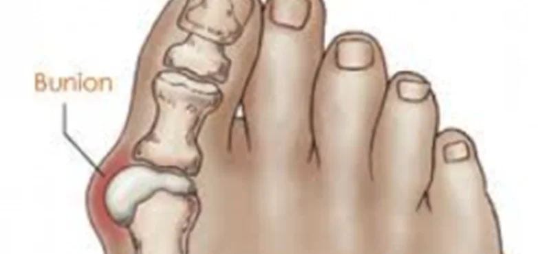 Hallux Valgus Bunion