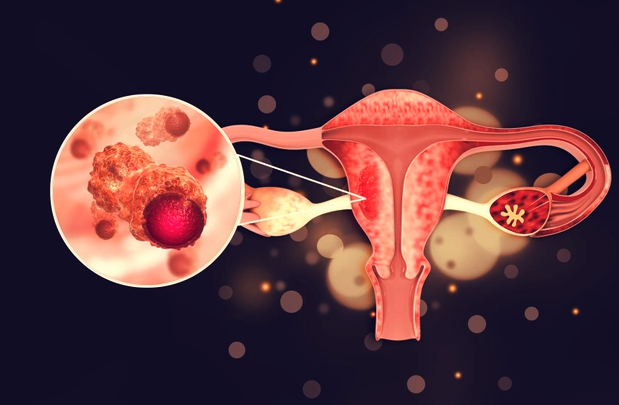 Ovarian Cancer Treatment Program - CubaHeal